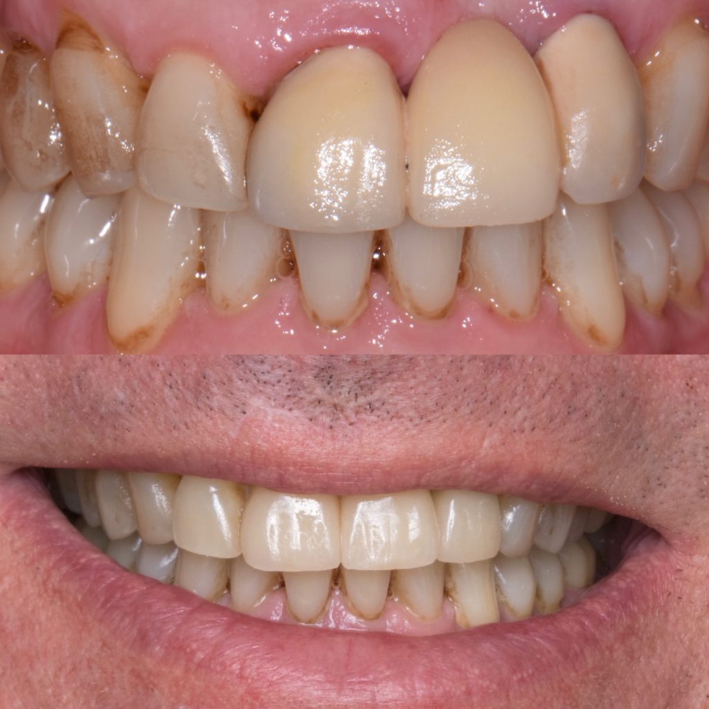 Dental Crowns Dentist Midtown East Manhattan, NYC | Inna Chern DDS FAGD